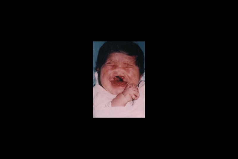 Massimo Grimaldi | Photos of Extreme Birth Deformities Caused by US ...