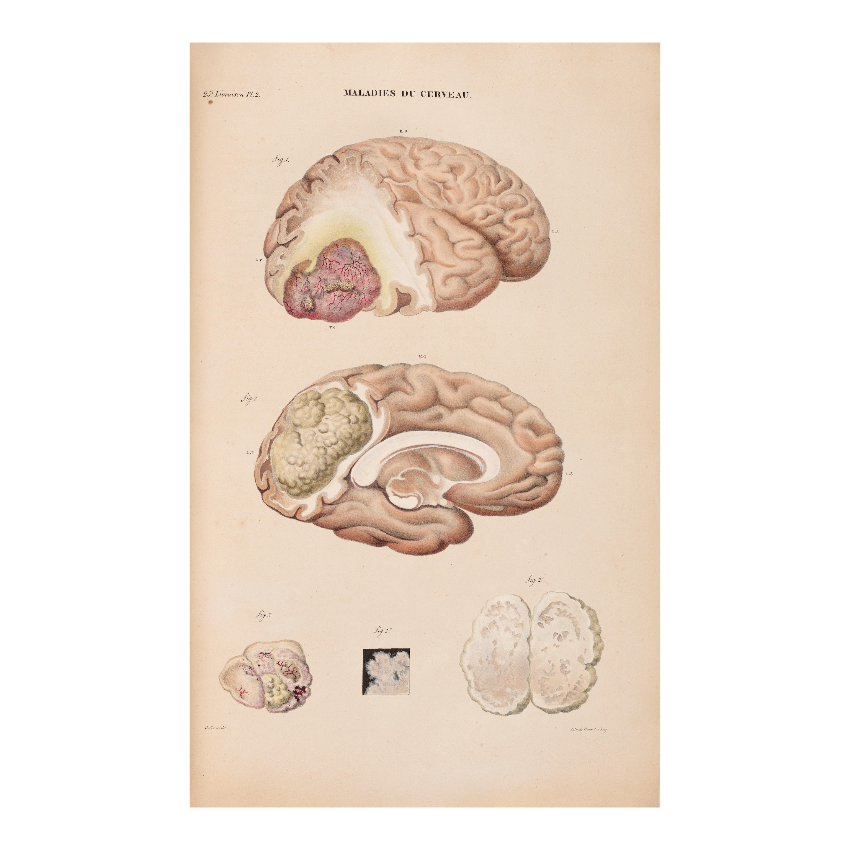 Antoine Toussaint de Chazal | Anatomie pathologique du corps humain ...
